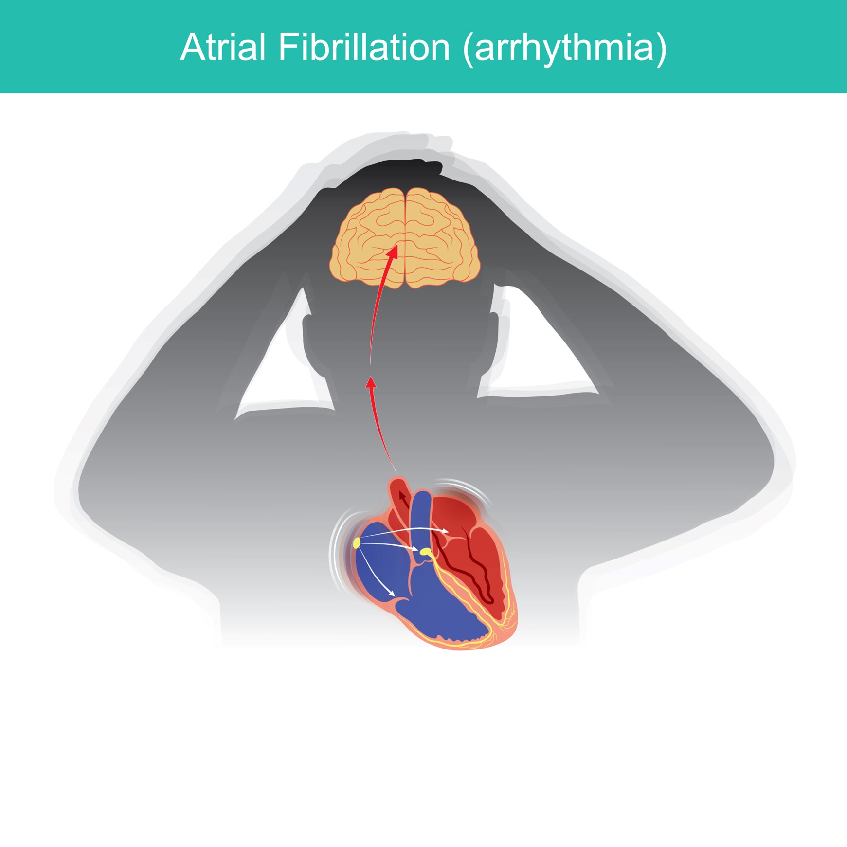 Understanding Atrial Fibrillation: The Dance of the Heart - Dr.Mansoor ...
